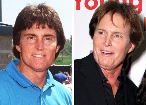 Bruce Jenner Before and After Plastic Surgery Photos Reveal More than ...